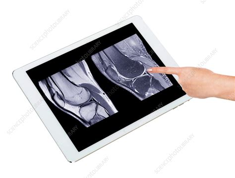 Knee Joint Mri Conceptual Image Stock Image F0433151 Science