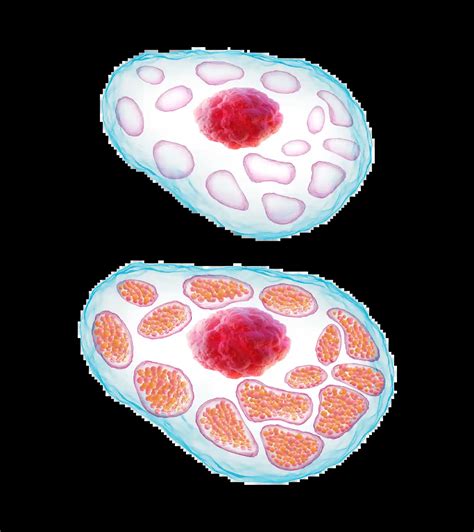 Disease Overview What Is Type 1 Gaucher Know Gaucher Disease