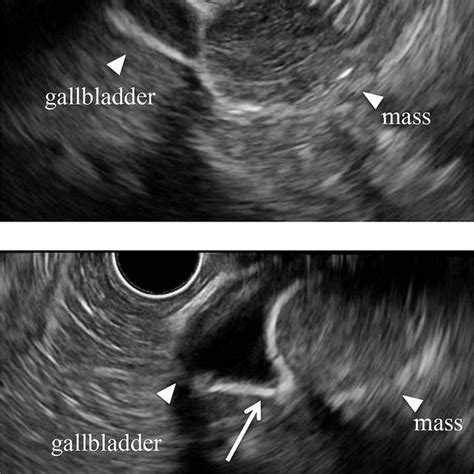Abdominal Ct A A Slightly Hyperdense Lesion At The Gallbladder
