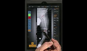 How Does Bone Lengthening Work International Center For Limb Lengthening