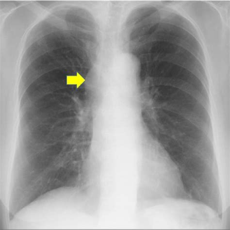 Chest Radiograph At The First Visit Chest Radiograph Showing The Right