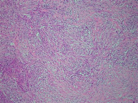 弥漫性恶性间皮瘤