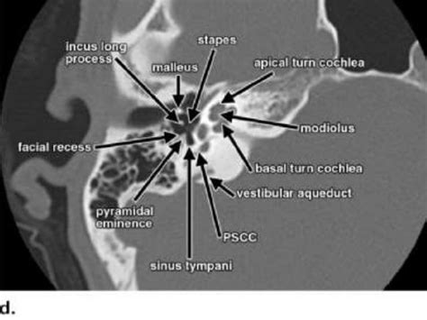 Mri Iac Anatomy