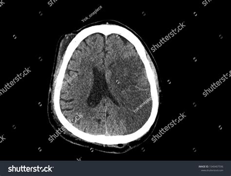 Cat Scan Brain Stroke