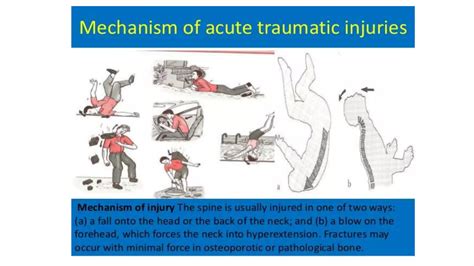 Fractures And Dislocation Spine Pptx