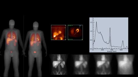 Simind Monte Carlo Program Medical Radiation Physics