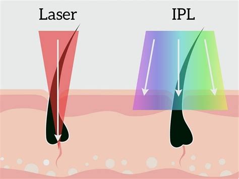 Ipl Vs Laser Hair Removal Setsuko Beauty Clinic