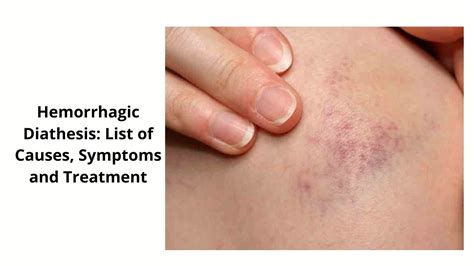 Hemorrhagic Diathesis Causes Symptoms And Treatment