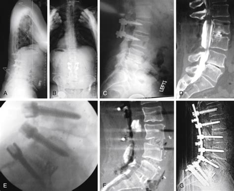L1 S1 Fusion When To Extend To T12 And Pelvis And When To Include L5