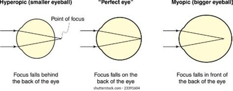 Hyperope Photos And Images Shutterstock