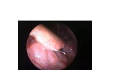 Pharyngitis N Oral Cavity Ppt