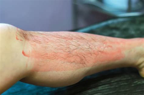 Hot Pink Wax Is Applied To A Woman`s Hairy Leg Hair Removal On The