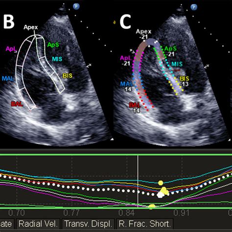 Representative Right Ventricular Longitudinal Strain Images Global