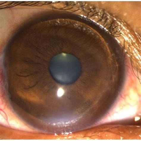 Peripheral Ulcerative Keratitis Puk With Epithelial Defect Stromal
