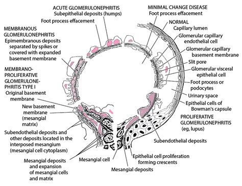 Membranous Nephropathy Genitourinary Disorders Merck Manual Professional Edition