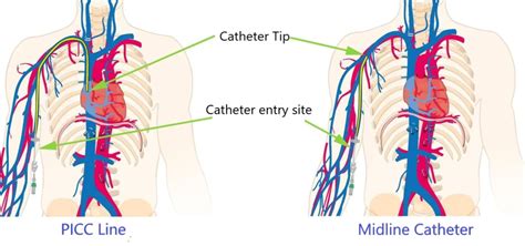 Streamlining Care Navigating The Essentials Of Picc Line Placement