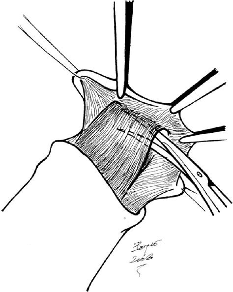 Longitudinal Dorsal Dartos Flap For Prevention Of Fistula After A Snodgrass Hypospadias