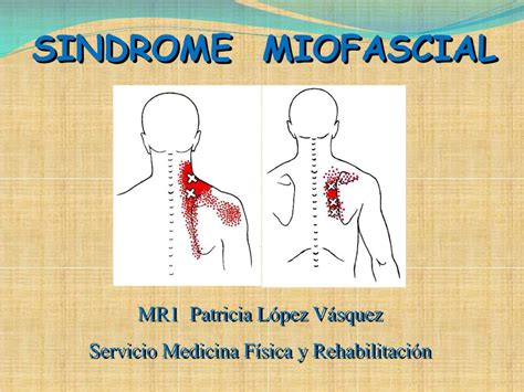 Ppt Sindrome Miofascial Powerpoint Presentation Free Download Id