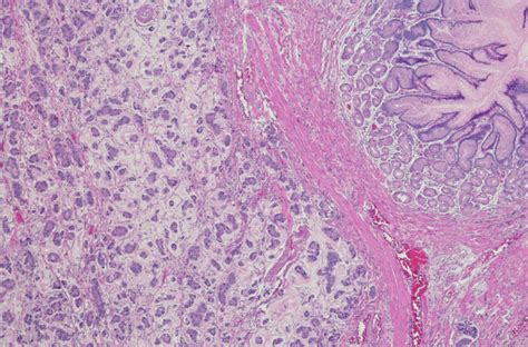 Gastric Linitis Plastica Diagnosis Uses Endoscopic And Radiologic