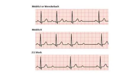 Conduction Disorders Pptx