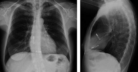 Expanding The Reach Of Leadless Pacemaker Technology Research