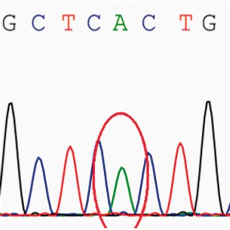Electropherogram Of The Patients Variant Showing A Homozygous