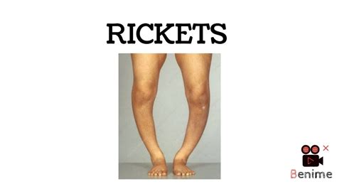 Rickets Orthopaedics Mbbs Neetpg Rickets Orthopaedics