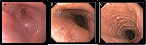 Endoscopic Evaluation Of The Eoe Patient Esophagus Esophageal Furrows Download Scientific