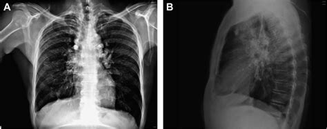 Eggshell Calcification Of Lymph Nodes In Silicosis The American