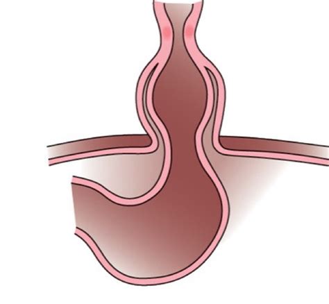 Patho Chpt 36 Alterations Of Digestive Function Flashcards Quizlet