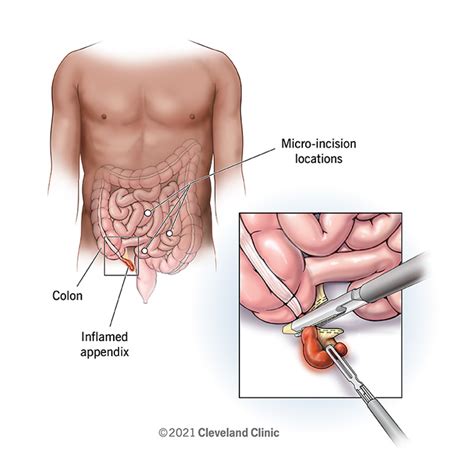Appendectomy Appendix Removal Surgery And Recovery