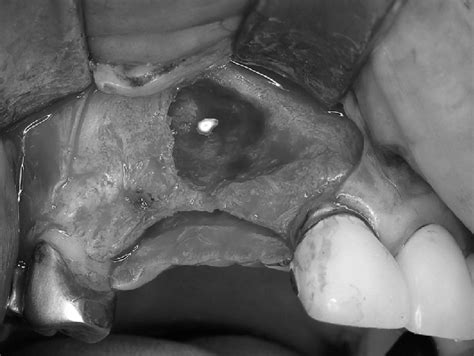 Bone Defect In The Anterior Maxilla Download Scientific Diagram