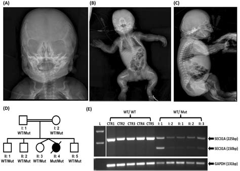 Biallelic Loss Of Function Variant In Sec31a Is Associated With Lethal Neurodevelopmental