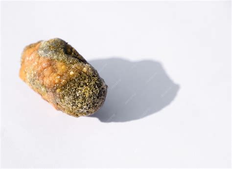 Premium Photo Stone Of Gallbladder The Result Of Gallstones A