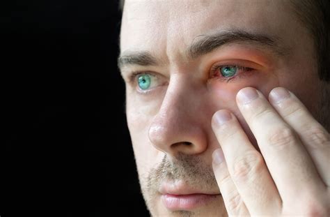 Is Blepharitis Contagious Abbotsford And Chilliwack