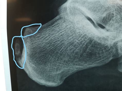 Sportul Si Ce Face El Din Calcaiele Noastre Cu Sau Fara Maladia Haglund Dr Paul Năstase