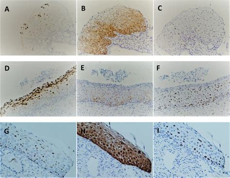 Accuracy Of Hpv E6e7 Mrna Examination Using In Situ Hybridization In