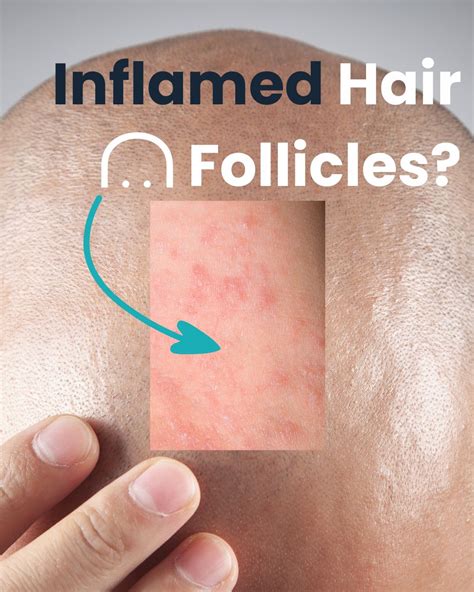 Inflamed Hair Follicles In Bald Men 7 Tips To Prevent Folliculitis On