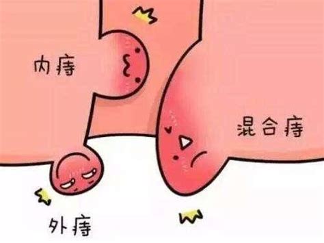 女性更易患痔疮的病因 知乎 女性更易患痔疮的病因 知乎
