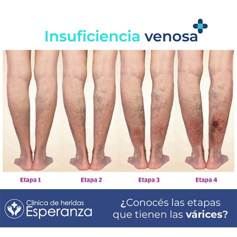 Clinica De Heridas Curación De Heridas Clinica De Heridas