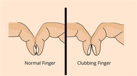 The Finger Test That Detects Early Lung Cancer Functional Medicine