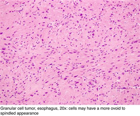 Pathology Outlines Granular Cell Tumor