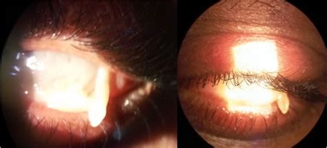Self Medication Complicating Pseudo Membranous Conjunctivitis Bmj
