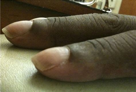 15 Fingernail And Toenail Abnormalities Indicators Of Patient Health