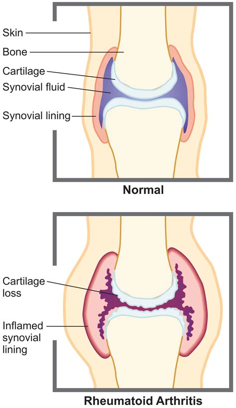 Rheumatoid Arthritis Diagram