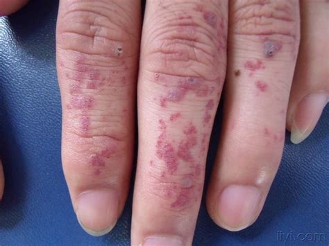 血管角化瘤阴囊血管角化瘤图片 伤感说说吧