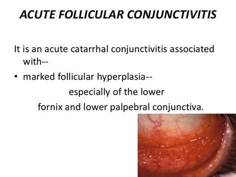 Follicular Conjunctivitis Causes