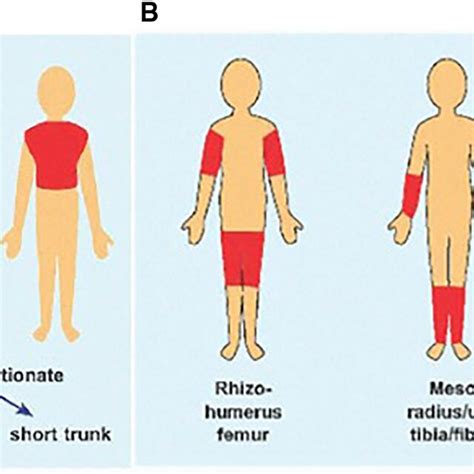 A Cartoon Showing Body Disproportion Short Limbs Vs Short Trunk Download Scientific