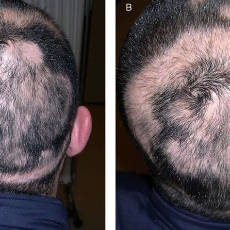Alopecia Areata Note Ophiasis Pattern Download Scientific Diagram