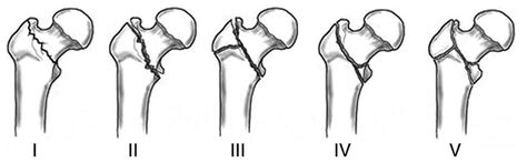 Evans Hip Fracture Classification